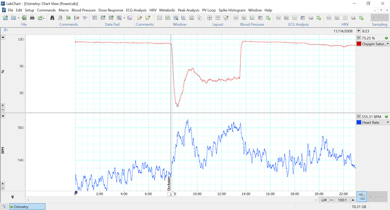 Pulse and Plethysmography | ADInstruments